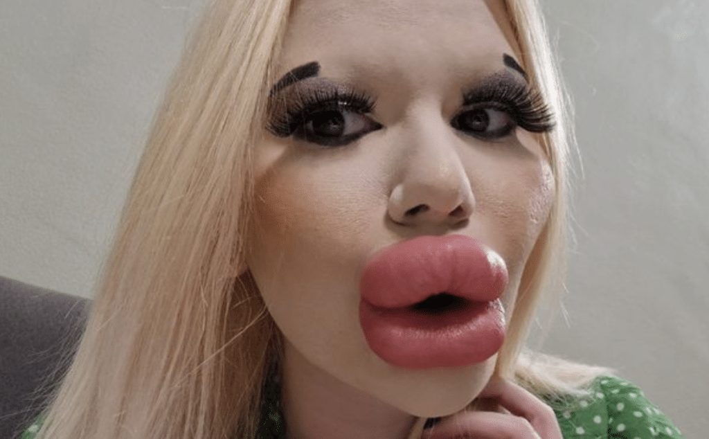 Vrouw Met ‘grootste Lippen Ter Wereld Worstelt Om Liefde Te Vinden