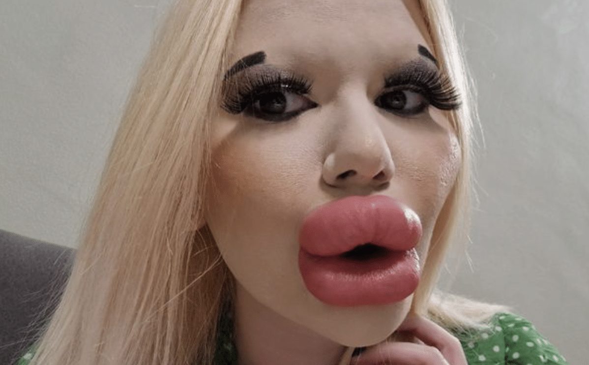 Vrouw Met ‘grootste Lippen Ter Wereld Worstelt Om Liefde Te Vinden